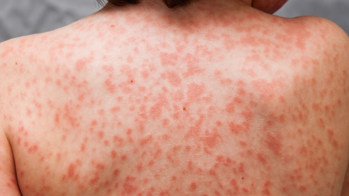 strawberry tongue kawasaki pictures